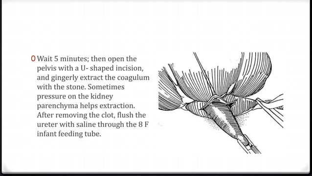 Open Pyelolithotomy | PPTX