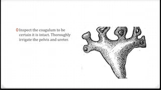 Open Pyelolithotomy | PPTX