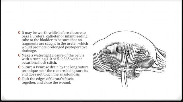 Open Pyelolithotomy | PPTX