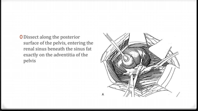 Open Pyelolithotomy | PPTX
