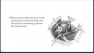 Open Pyelolithotomy | PPTX