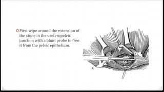 Open Pyelolithotomy | PPT