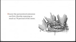 Open Pyelolithotomy | PPTX
