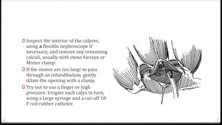 Open Pyelolithotomy | PPT