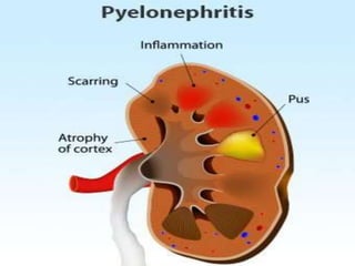 Pyelonephritis, ACUTE PYELONEPHRITIS, CHRONIC PYELONEPHRITIS,