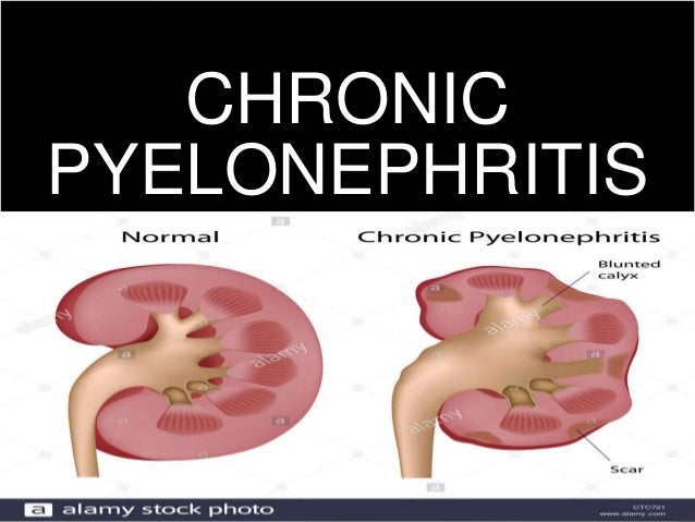 Pyelonephritis, ACUTE PYELONEPHRITIS, CHRONIC PYELONEPHRITIS,