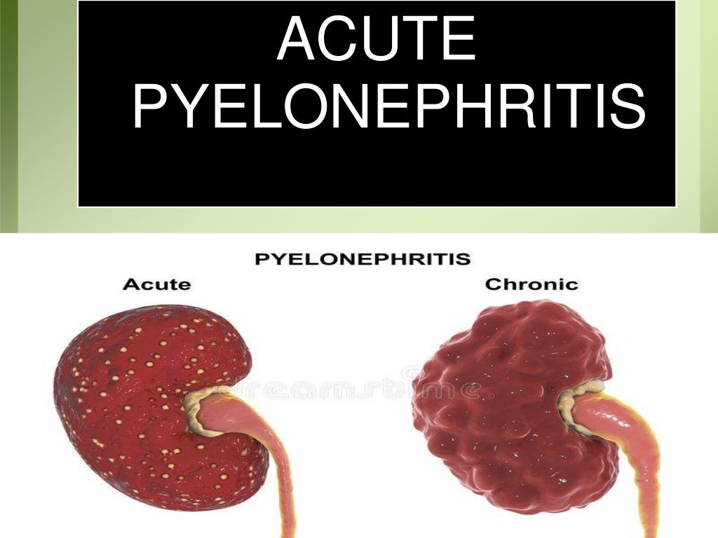 Pyelonephritis, ACUTE PYELONEPHRITIS, CHRONIC PYELONEPHRITIS,
