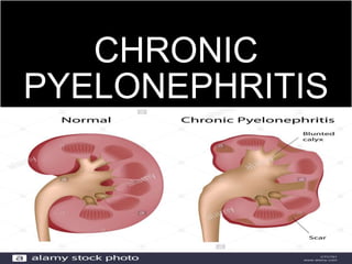 pyelonephritis-1807041752273433 (2).pptx
