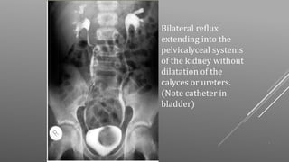 Pyelonephritis.pptx