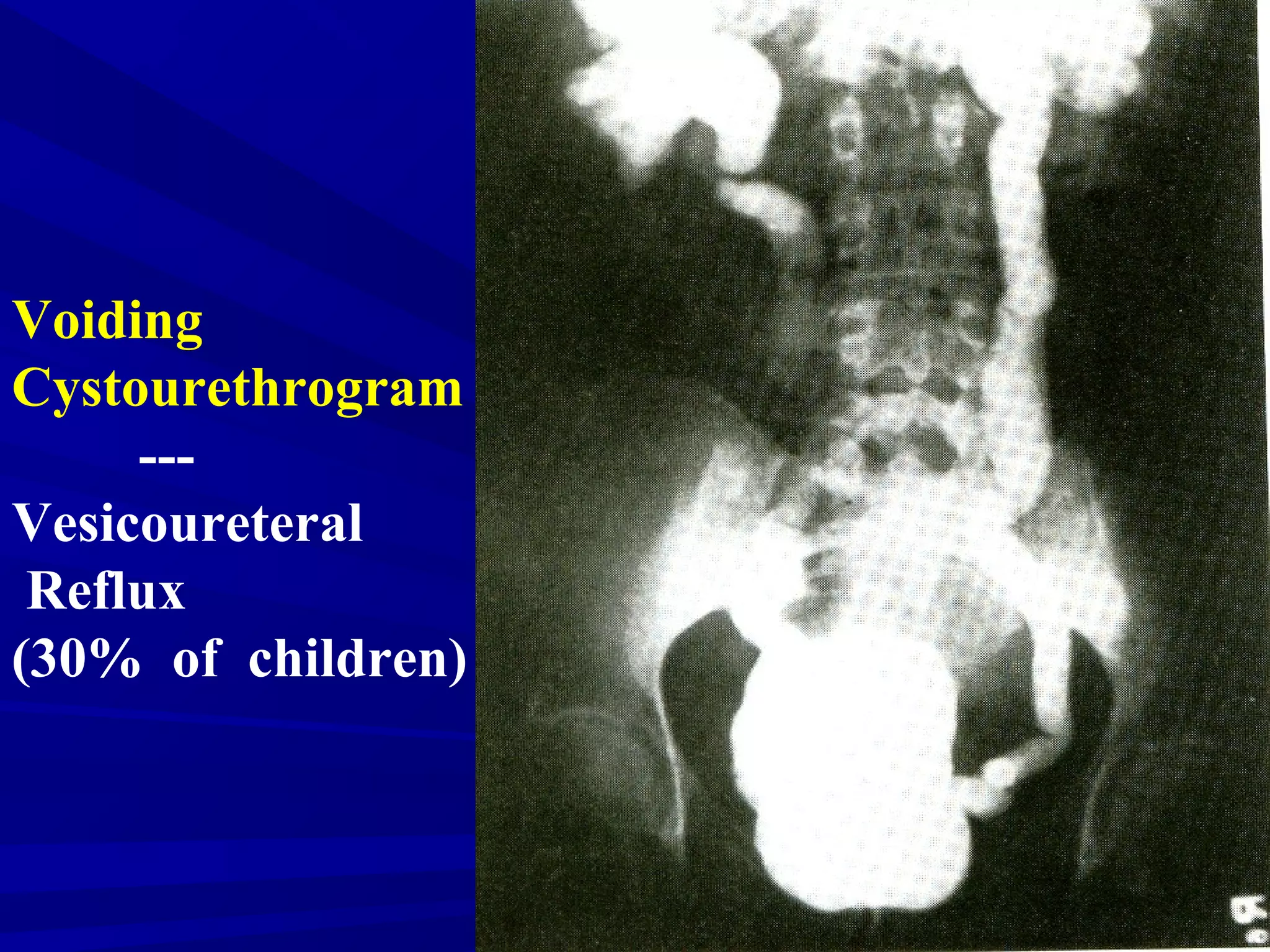 Pyelonephritis csbrp | PPT