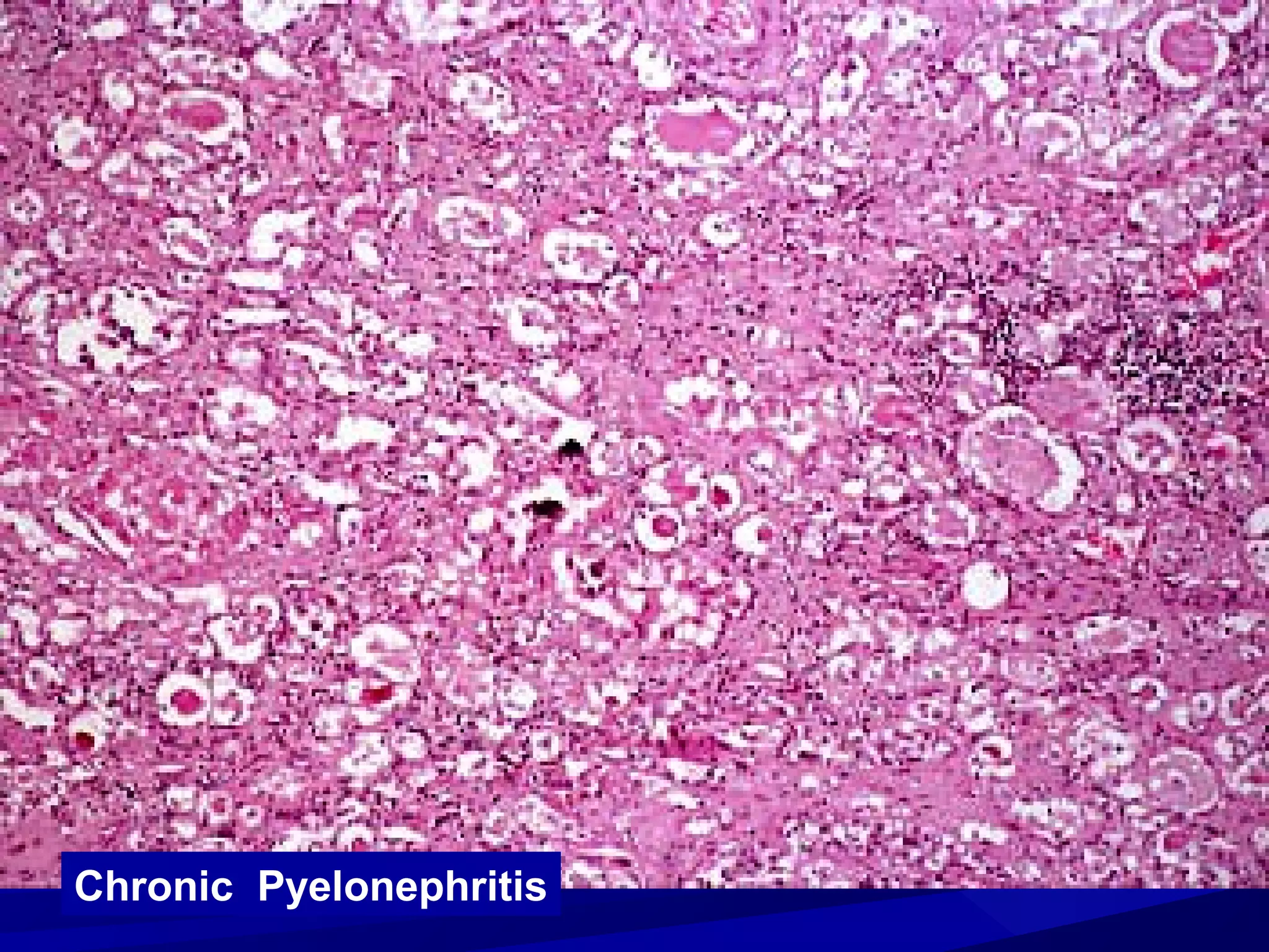 Pyelonephritis csbrp | PPT