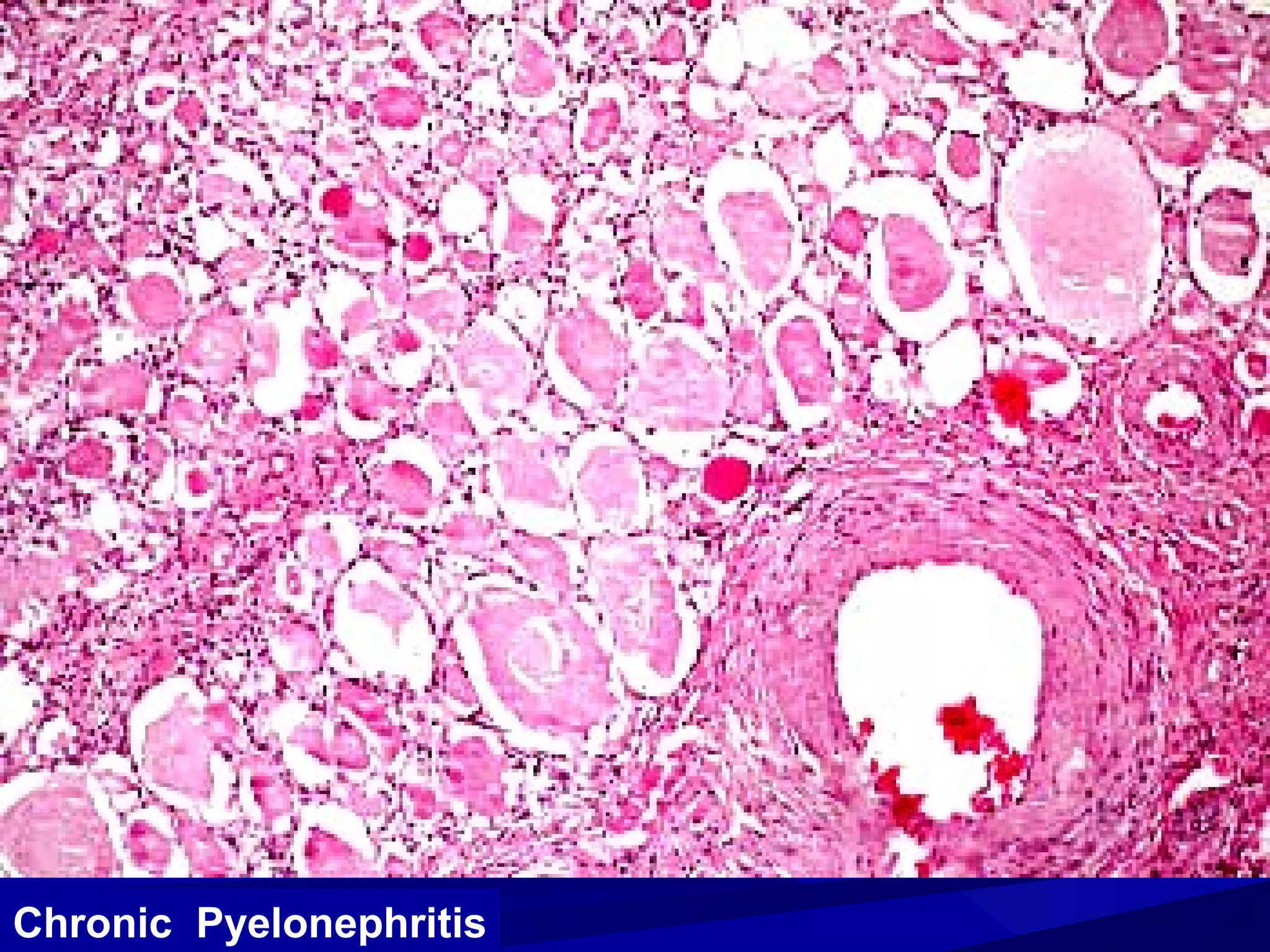 Pyelonephritis csbrp | PPT