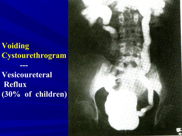 Pyelonephritis csbrp | PPT