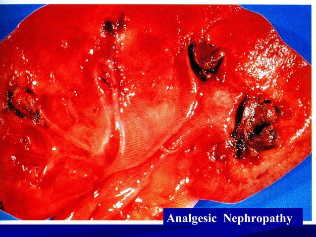 Pyelonephritis csbrp | PPT