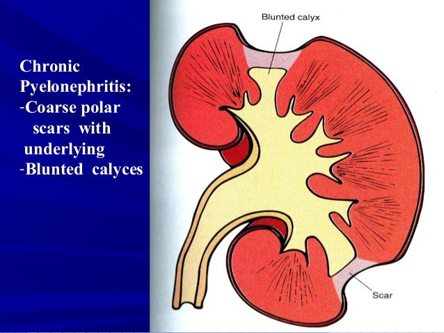 Pyelonephritis csbrp
