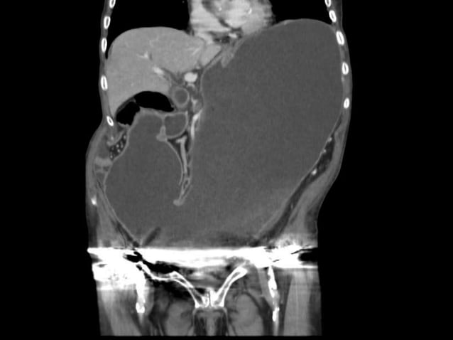 Pyloric obstruction coronal | PPTX