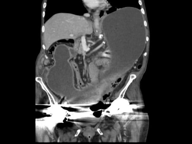 Pyloric obstruction coronal | PPTX