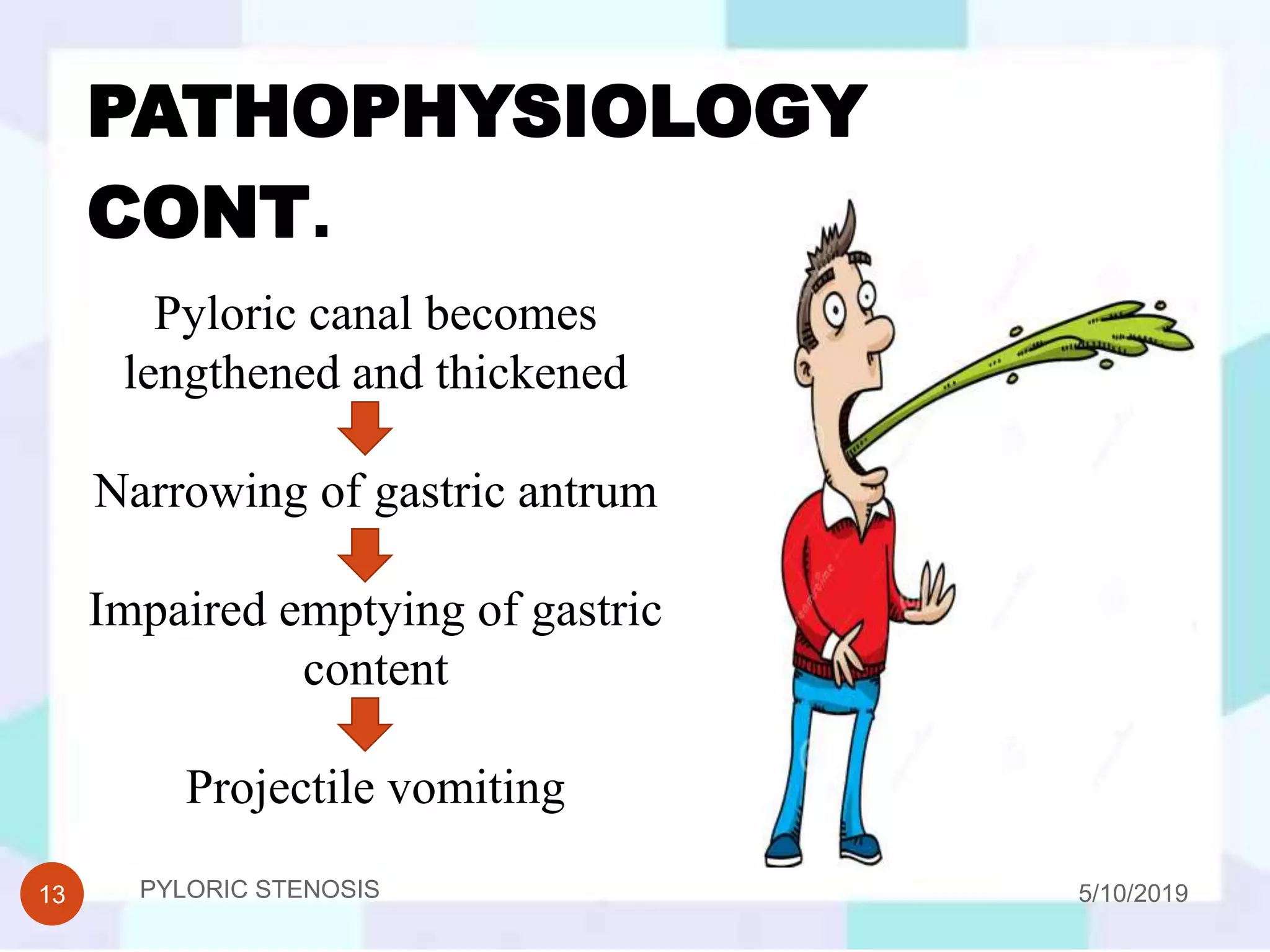 Pyloric stenosis | PPTX