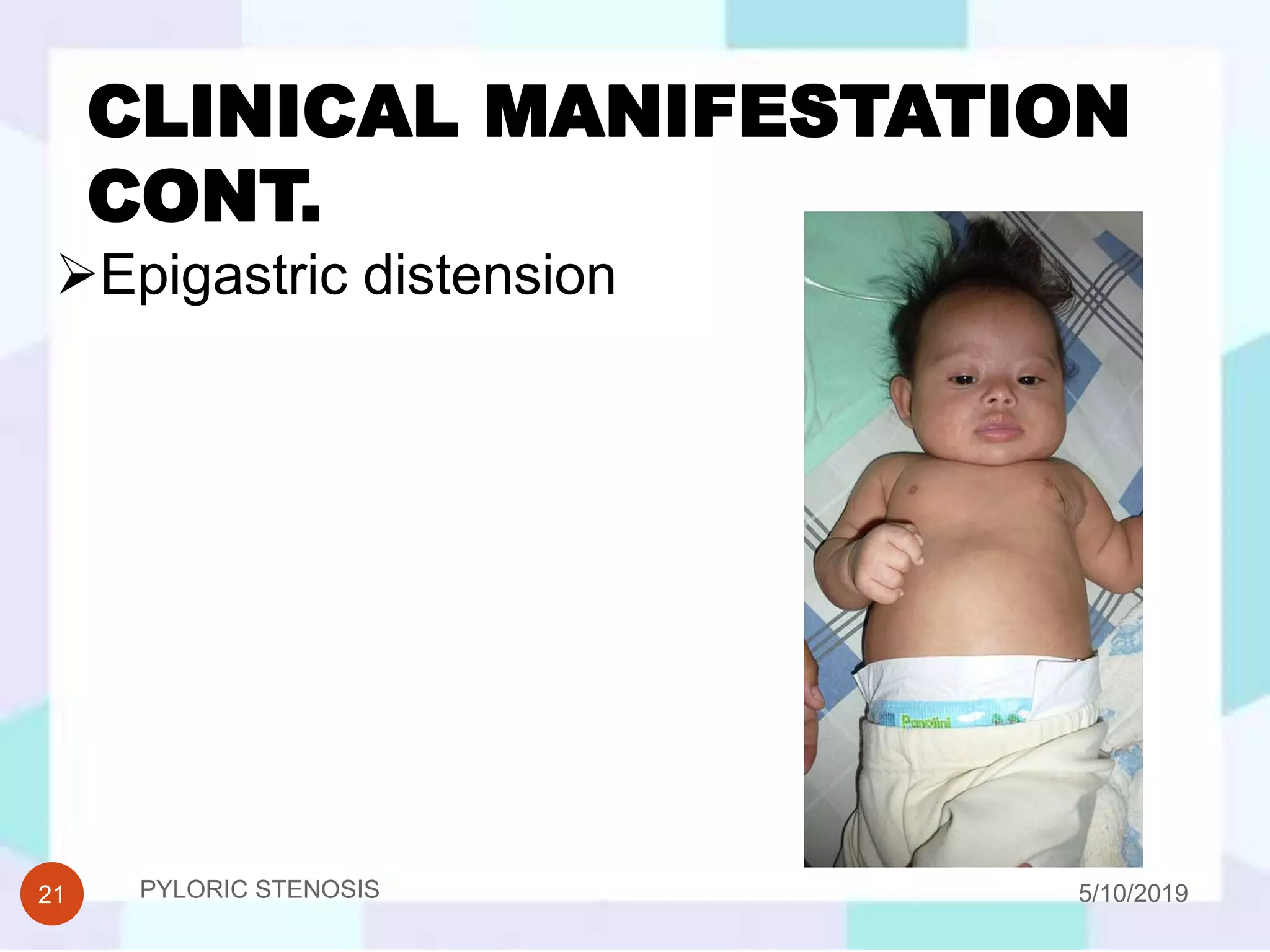 Pyloric stenosis | PPTX