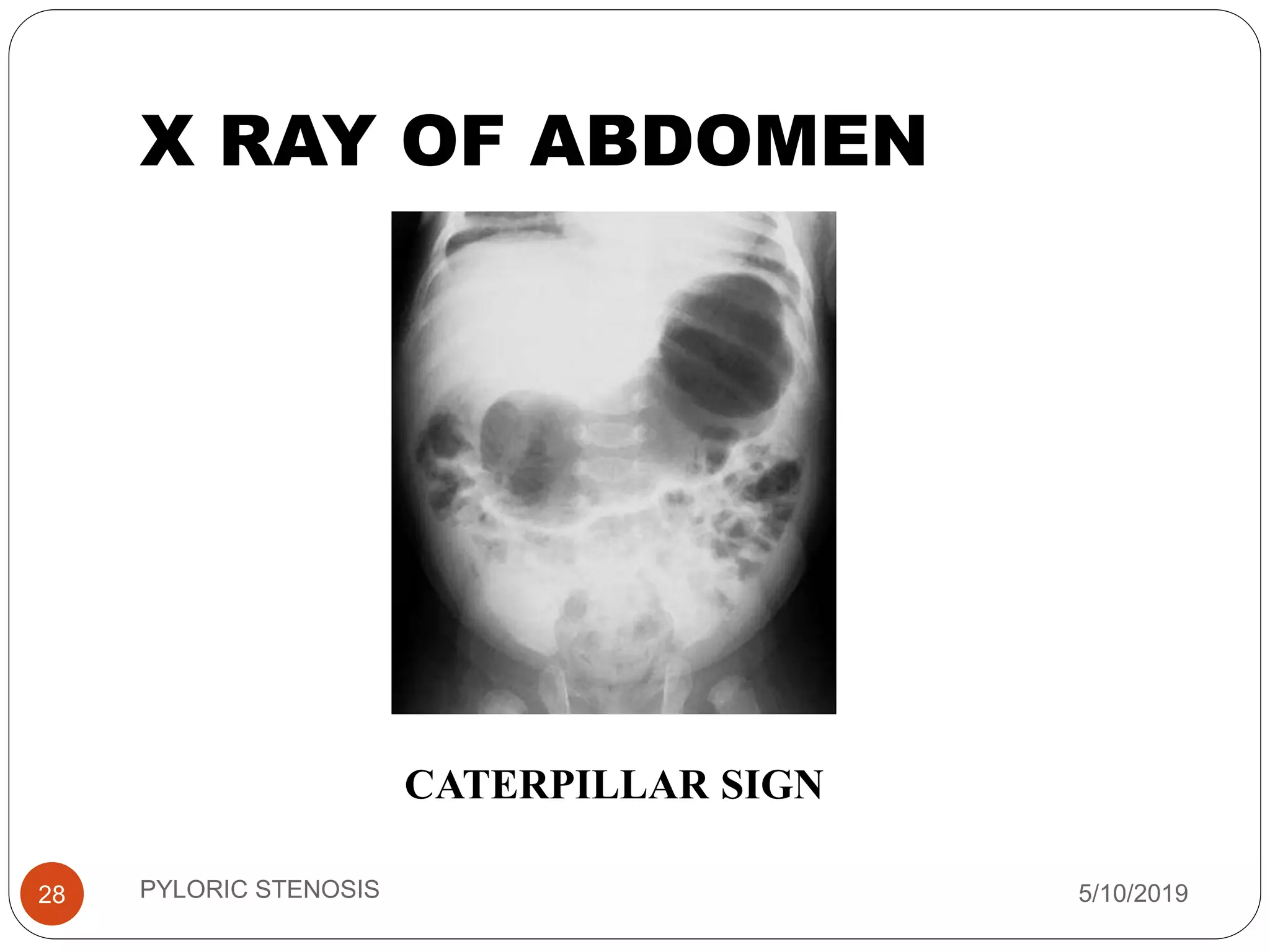 Pyloric stenosis | PPTX