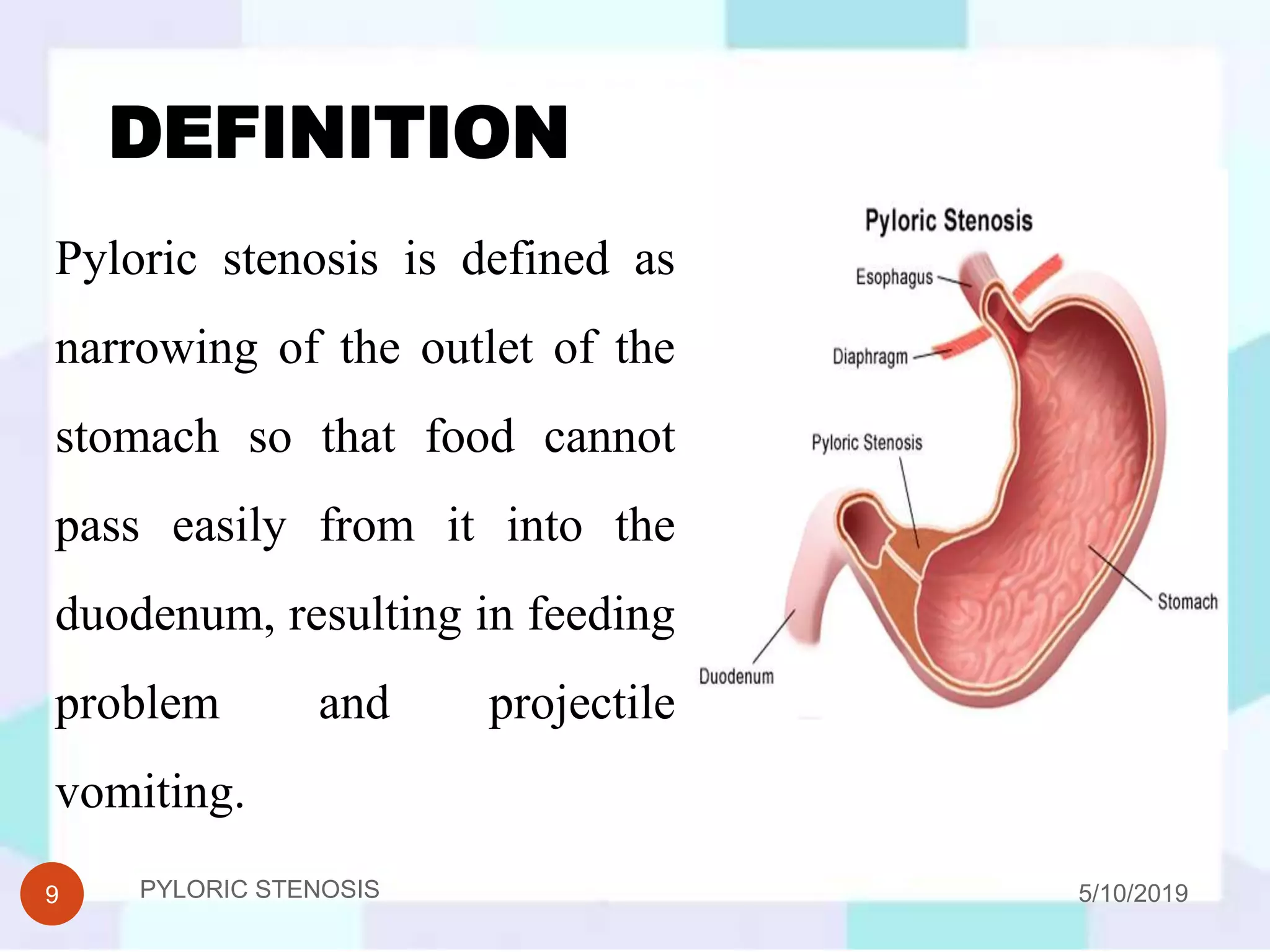 Pyloric stenosis | PPTX