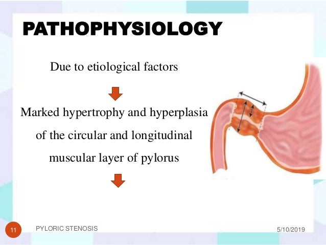 Pyloric stenosis