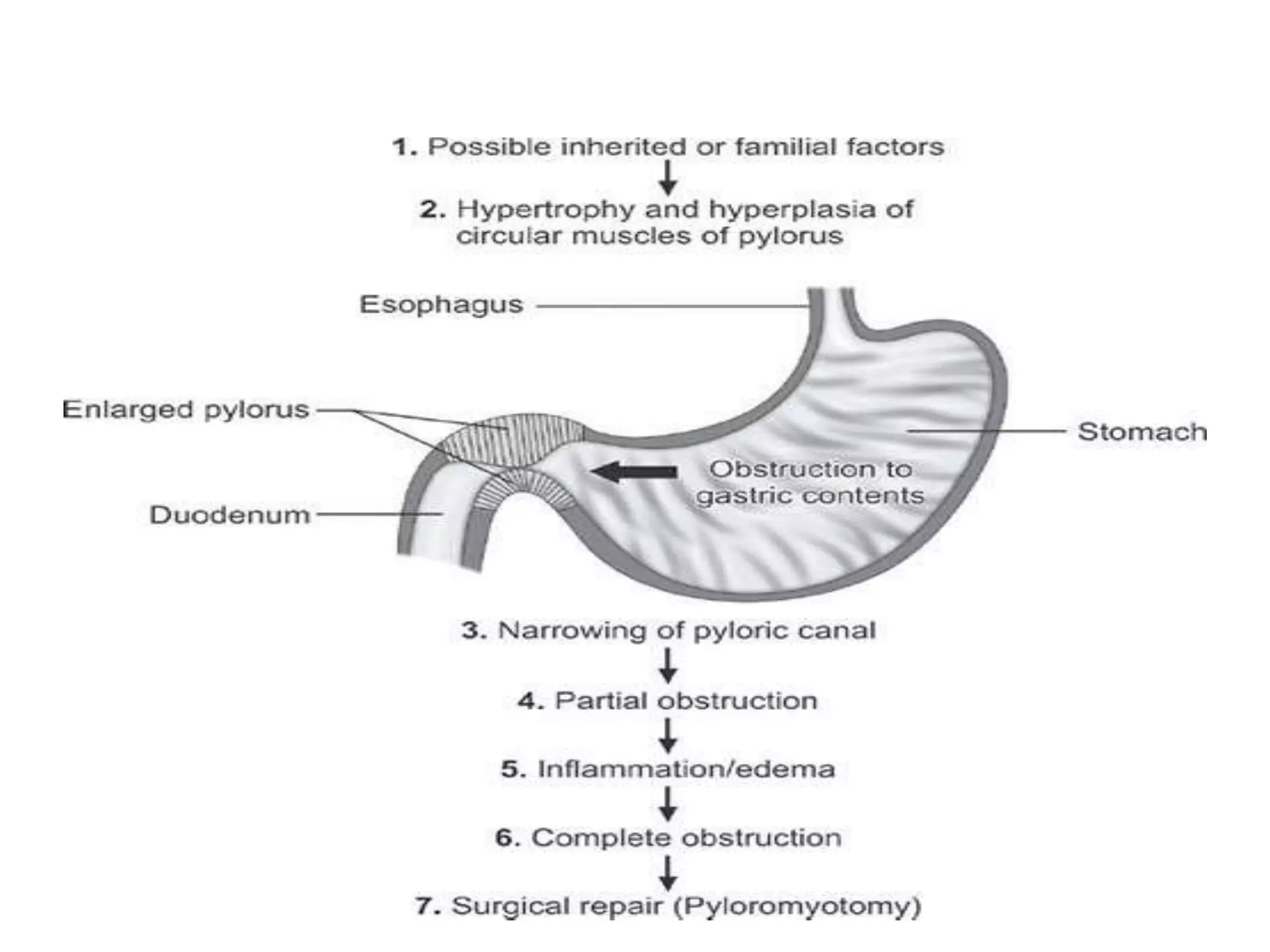 Pyloric Stenosis.pptx