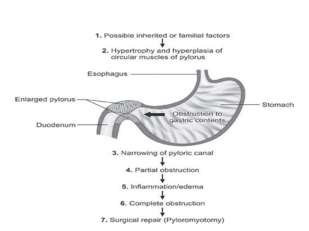 Pyloric Stenosis.pptx