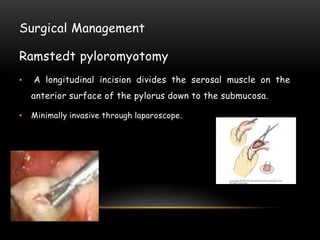 Pyloric stenosis.pptx