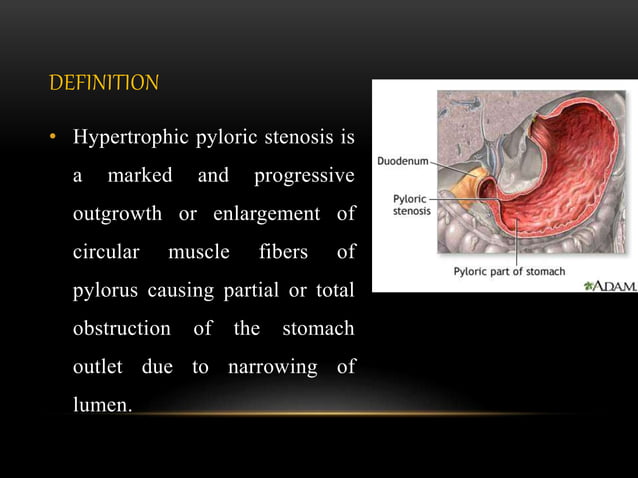 Pyloric stenosis.pptx | Pregnancy | Reproductive Health