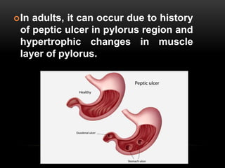Pyloric stenosis.pptx