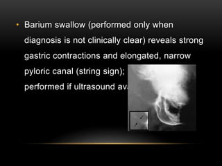 Pyloric stenosis.pptx