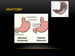 Pyloric stenosis.pptx