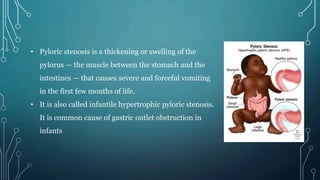 Pyloric stenosis.pptx