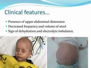 Pyloric Stenosis.pptx
