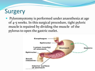 Pyloric Stenosis.pptx