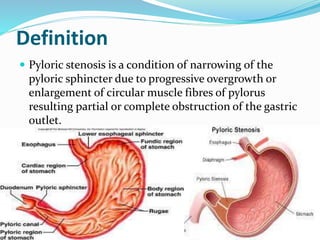 Pyloric Stenosis.pptx