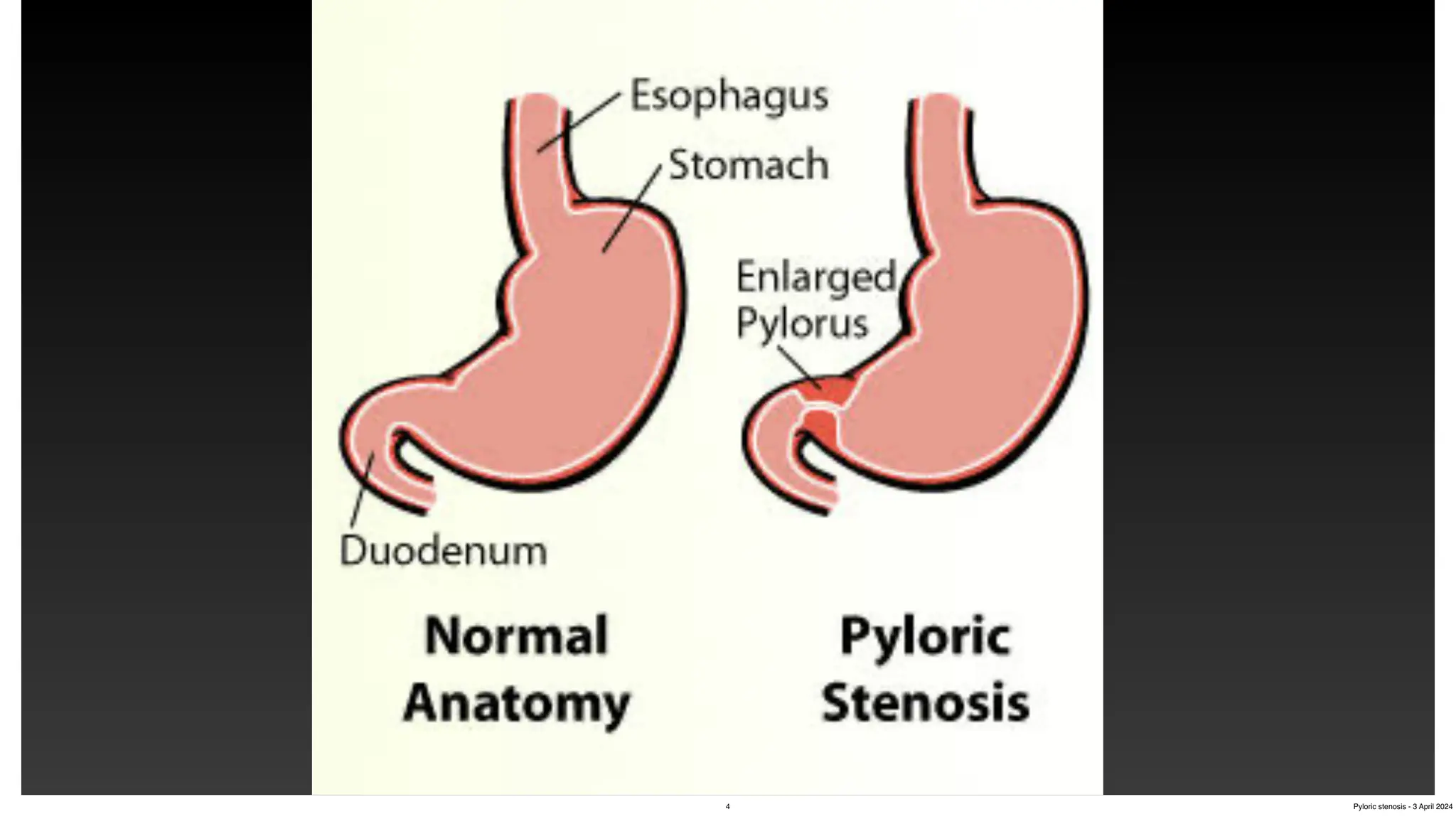 Pyloric stenosis-Child health nursing... | PDF