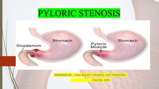 Nursing Management of Patients with PYLORIC STENOSIS.pptx