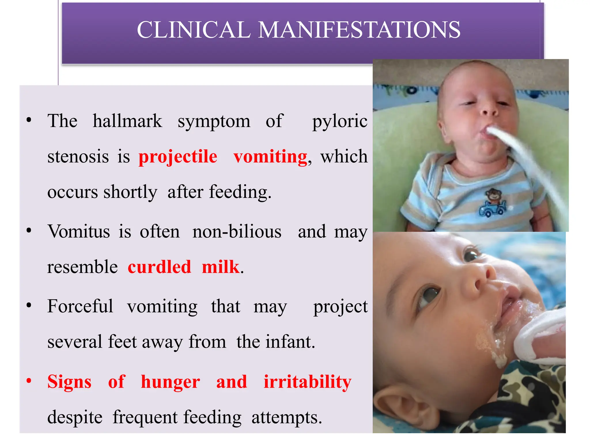 pyloric stenosis .pptx