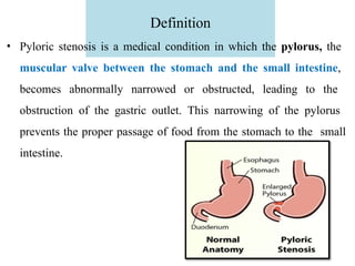pyloric stenosis .pptx
