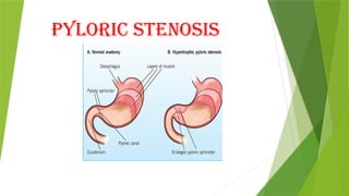 PYLORIC STENOSIS BAMS 4th year Shalya tantra | PPTX