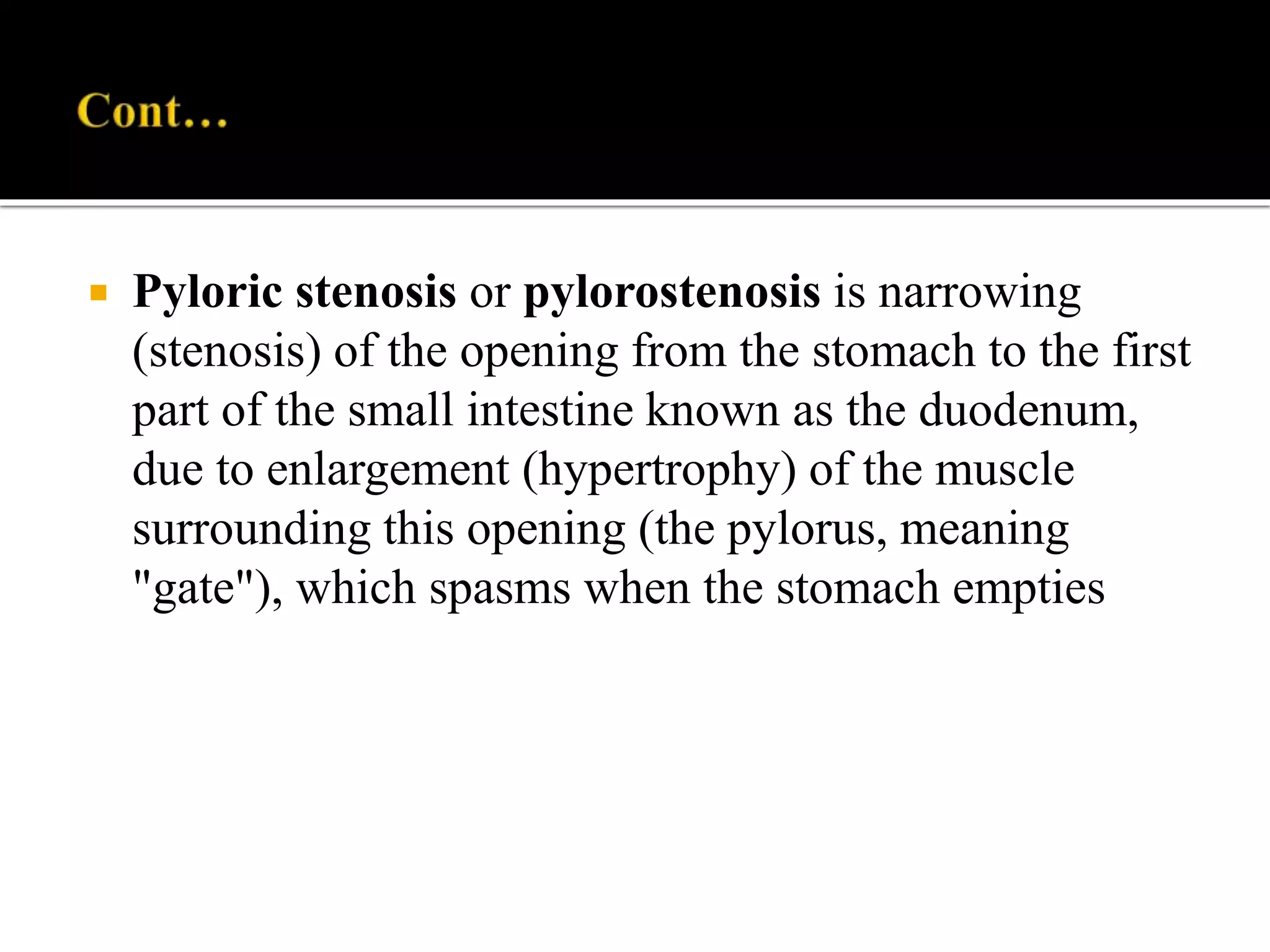 Pyloric stenosis notes | PPTX