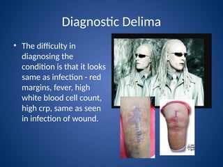 Pyoderma gangrenosum and Post Surgical Pyoderma Gangrenosum | PPTX