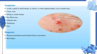 PYODERMA, IMPETIGO, FOLLICULITIS, FURUNCLES, CARBUNCLES.pdf
