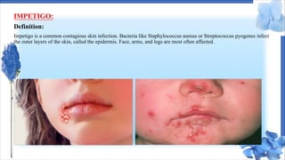 PYODERMA, IMPETIGO, FOLLICULITIS, FURUNCLES, CARBUNCLES.pdf