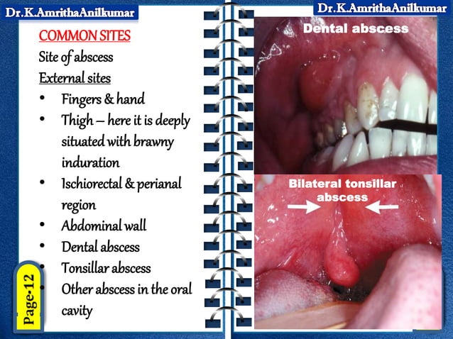 Pyogenic abscess by Dr.K.AmrithaAnilkumar | PPTX | Ear, Nose and Throat ...