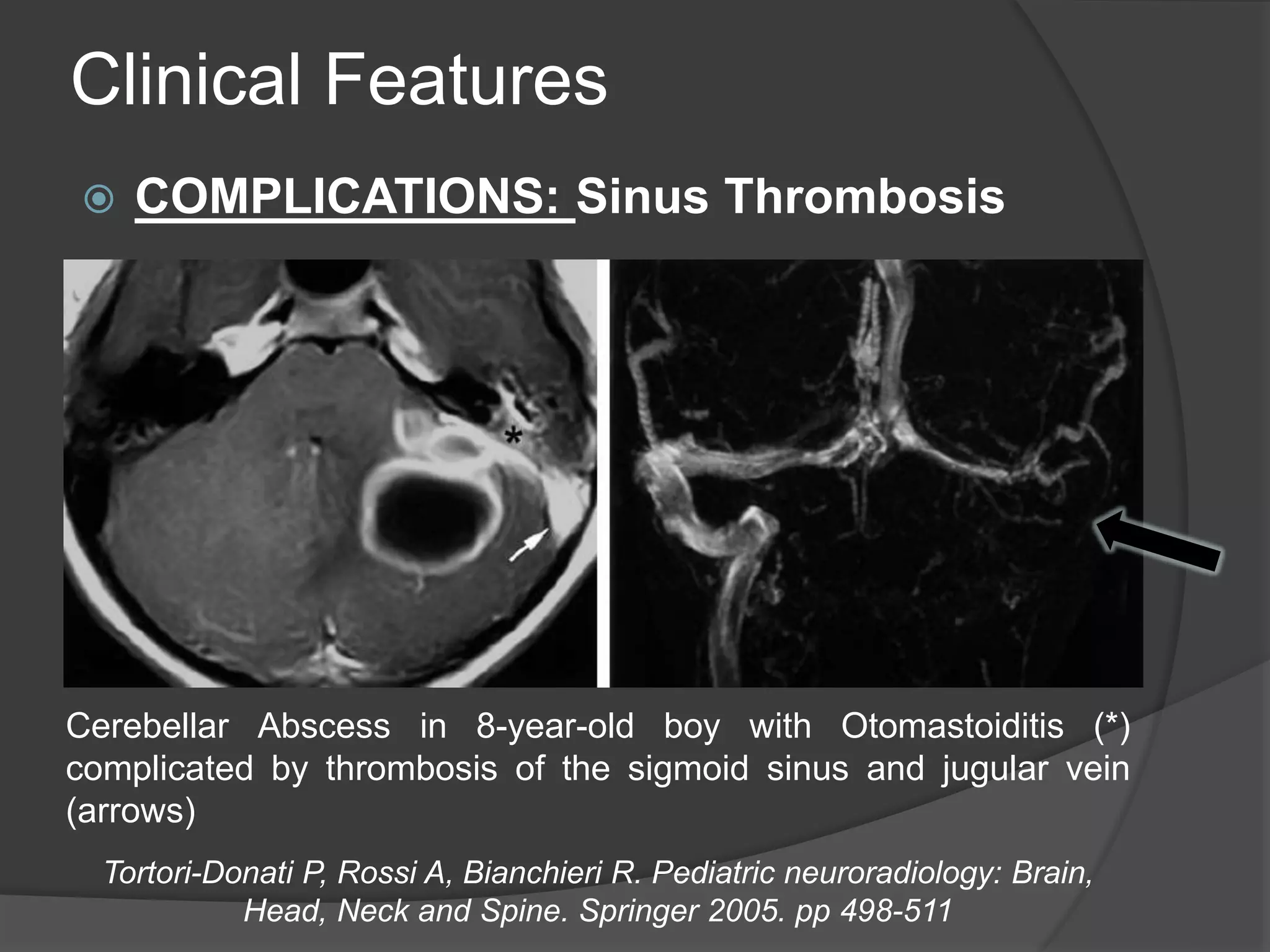 Magnetic resonance features of pyogenic brain abscesses and ...