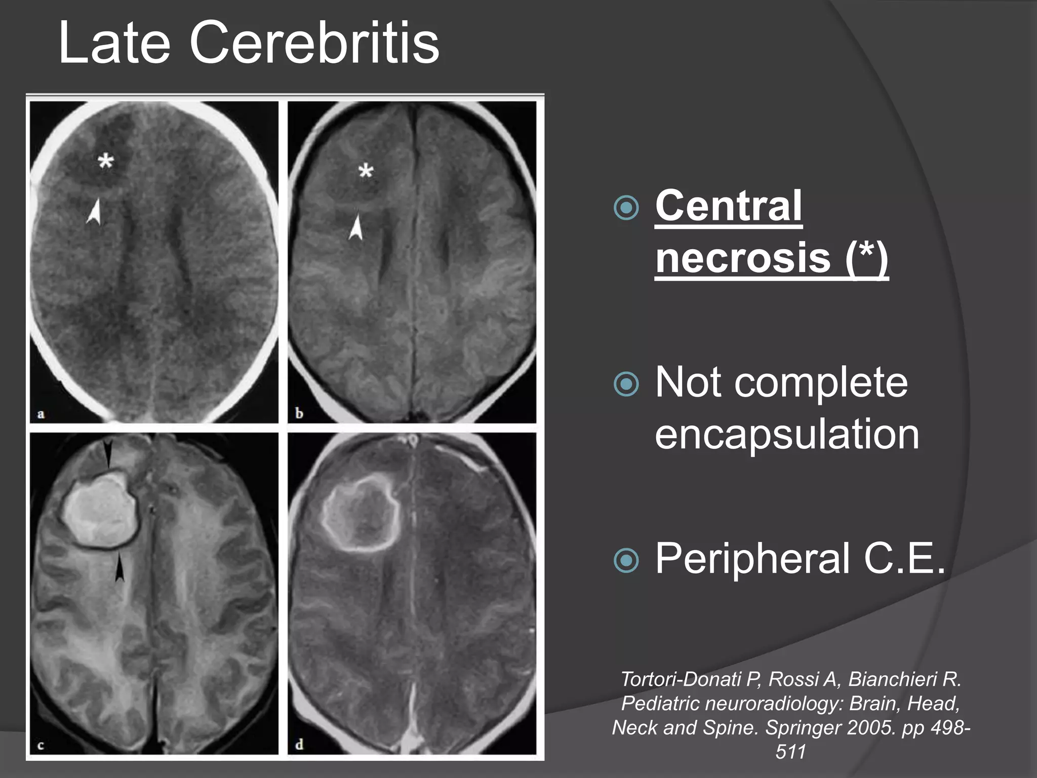 Magnetic resonance features of pyogenic brain abscesses and ...