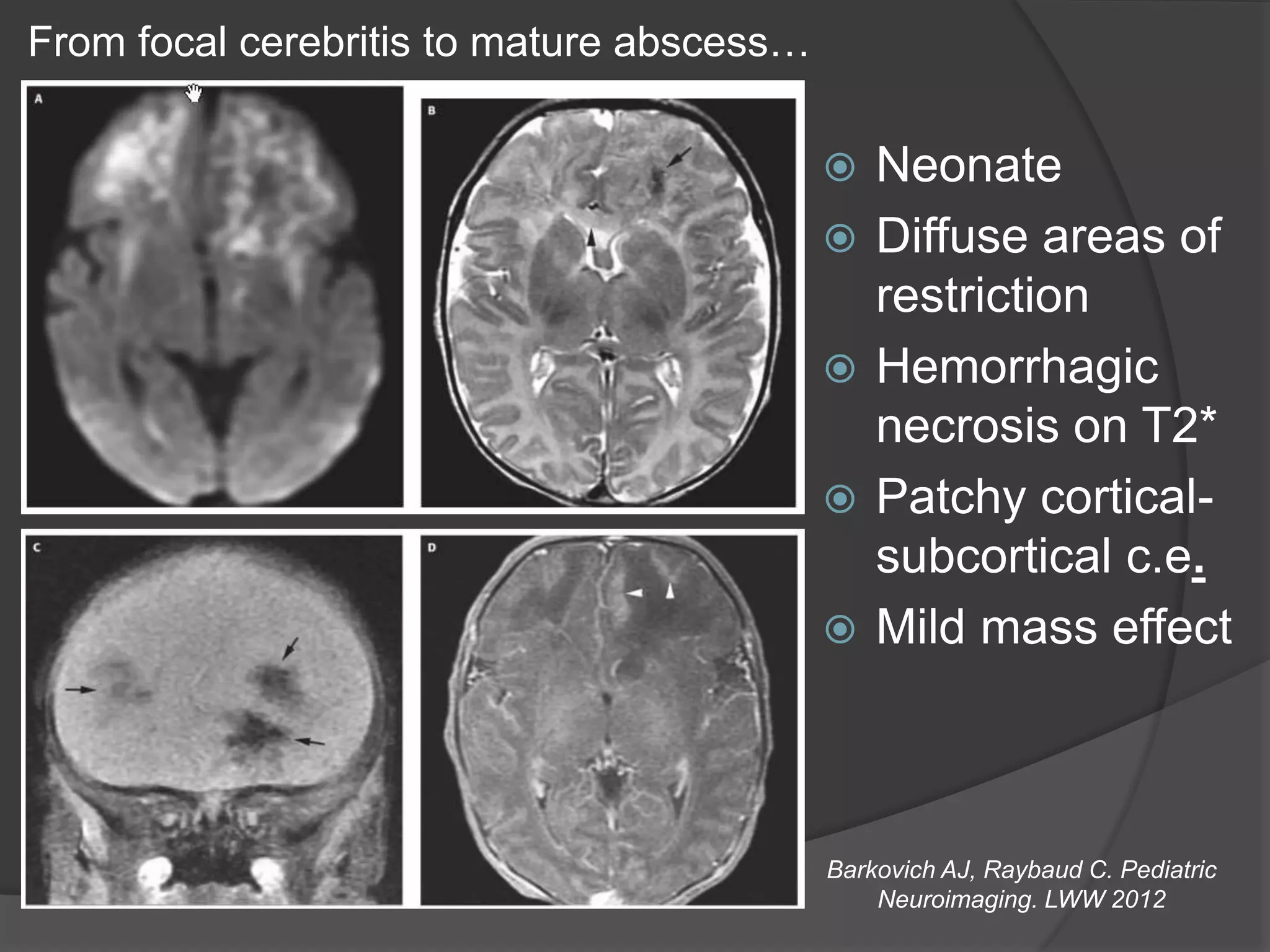 Magnetic resonance features of pyogenic brain abscesses and ...